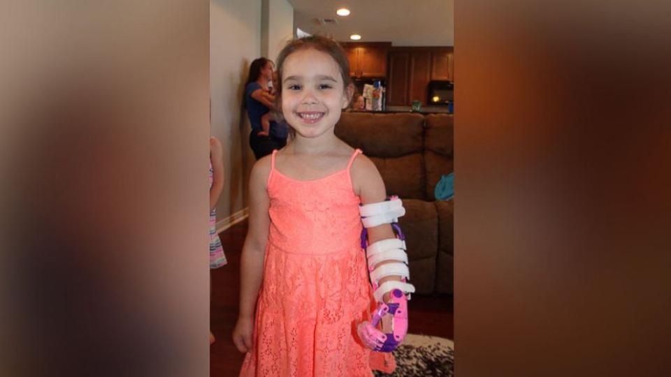 5-year-old girl in Texas gets 3D printed prosthetic arm from her local ...