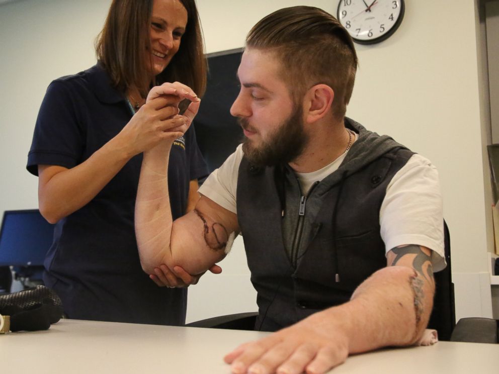 Retired Marine who underwent double arm transplant wiggles fingers ...